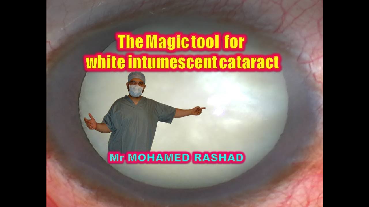 Magic tool for White Intumescent Cataractالأداة السحرية لعملية المياة ...