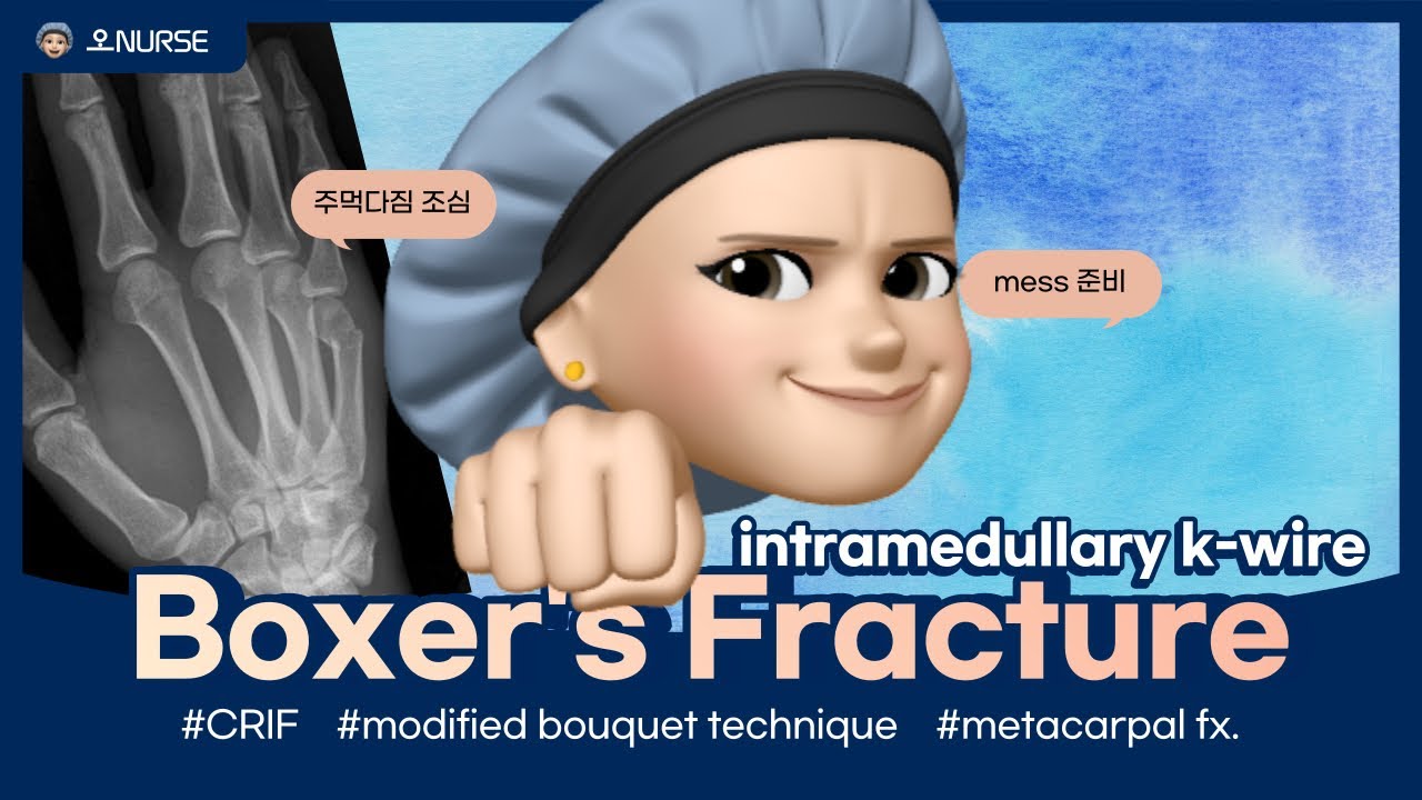 CRIF-5th metacarpal fracture(intramedullary k-wire) - YouTube