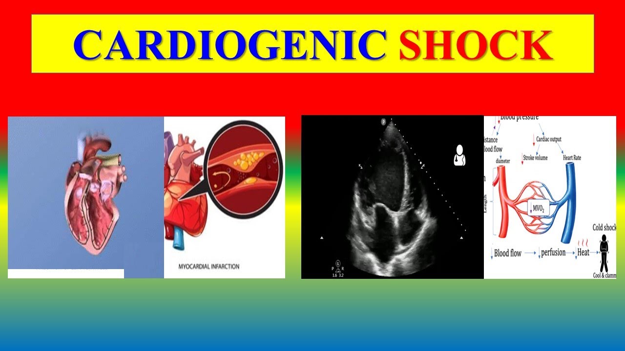CARDIOGENIC SHOCK - Define , etiologies , pathophysiological , symptoms ...