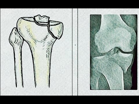 Posteromedial Approach to the Proximal Tibia - YouTube