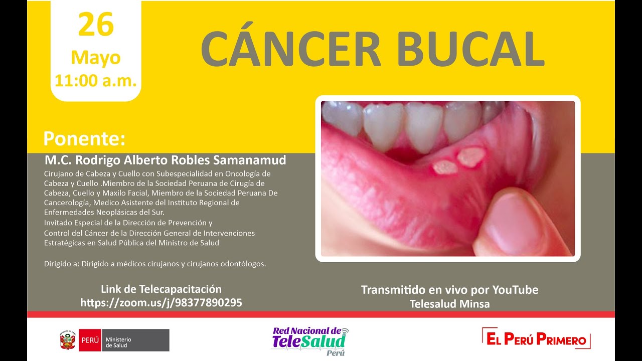 Fotos De Cancer En La Boca Cáncer De Boca Síntomas Y Causas Mayo