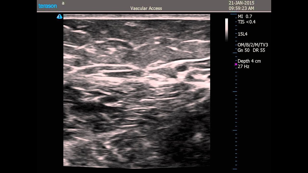 Thigh Reticular Spider Complexes Caused by Boyd’s Perforator (Posterior ...