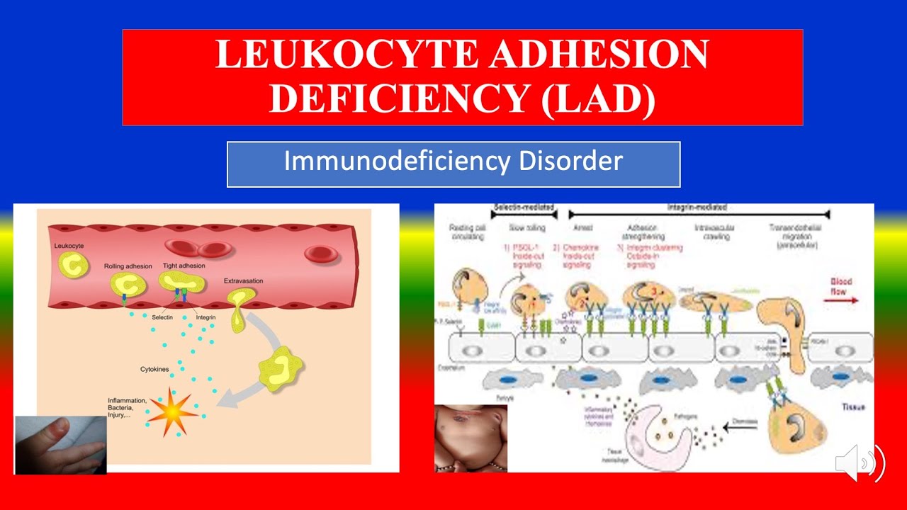 Leukocyte Adhesion Deficiency Type 2