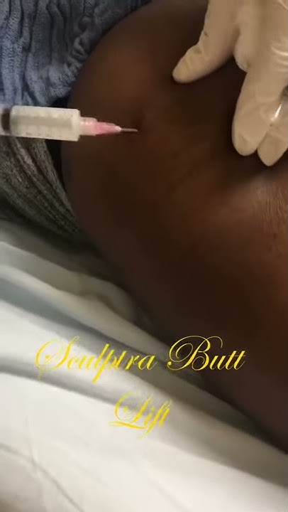 Sculptra Butt Lift | Tampa with Dr. BBL - YouTube