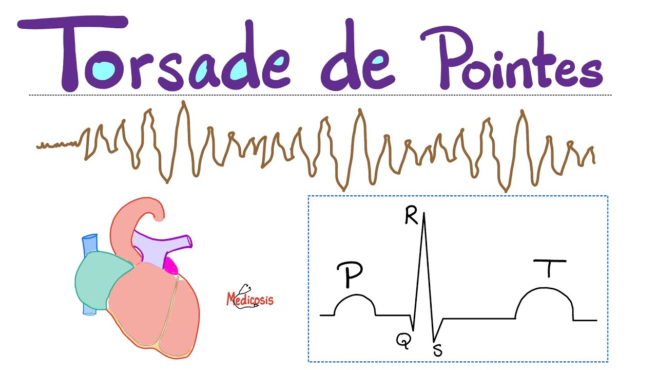 Torsade de Pointes - Prolonged QT interval - Long QT Syndrome ...