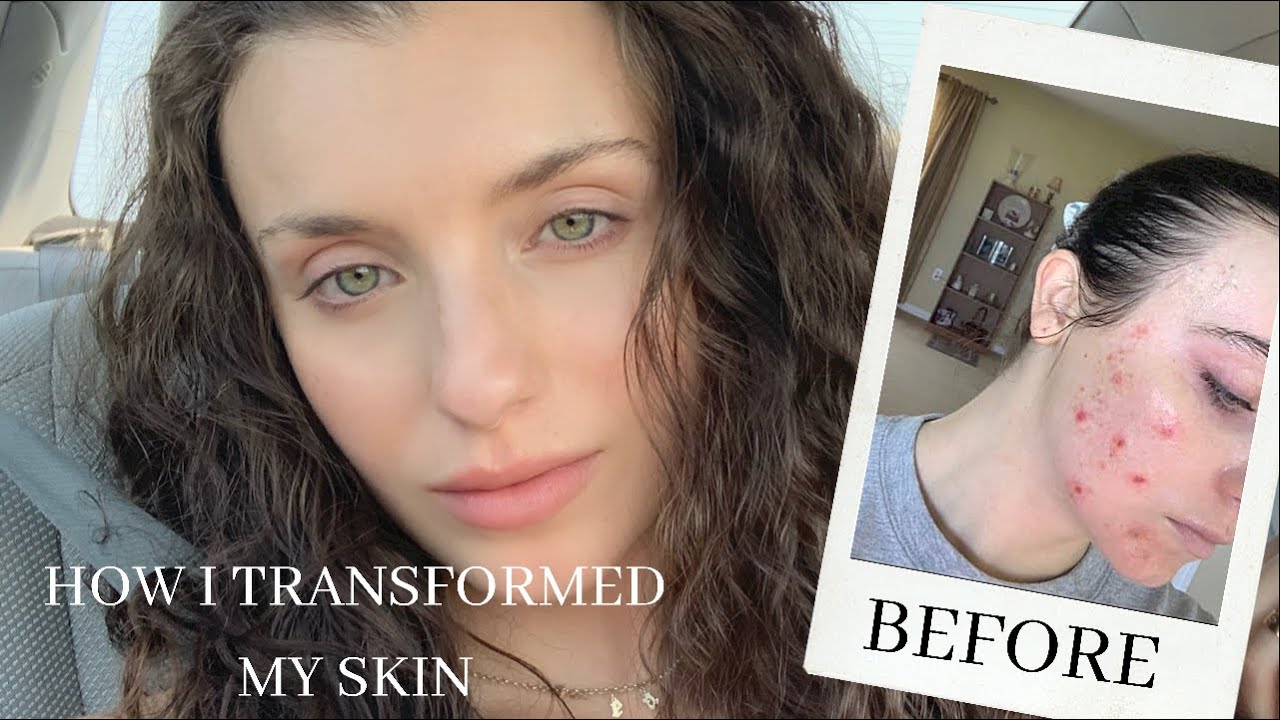 HOW I TRANSFORMED MY SKIN! - YouTube