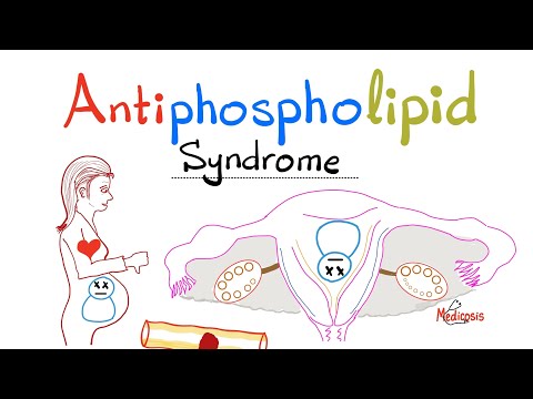Antiphospholipid Antibody Syndrome (APS) - Thrombophilia - Hypercoagulability, Pregnancy, Migraine 