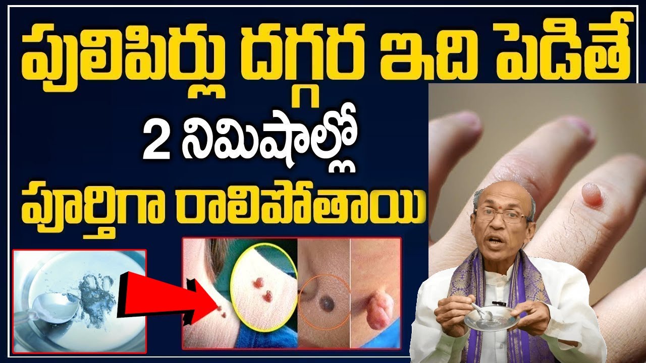 పులిపిర్లు దగ్గర ఇది పెడితే నొప్పి లేకుండా రాలిపోతాయి | Pulipirlu ...