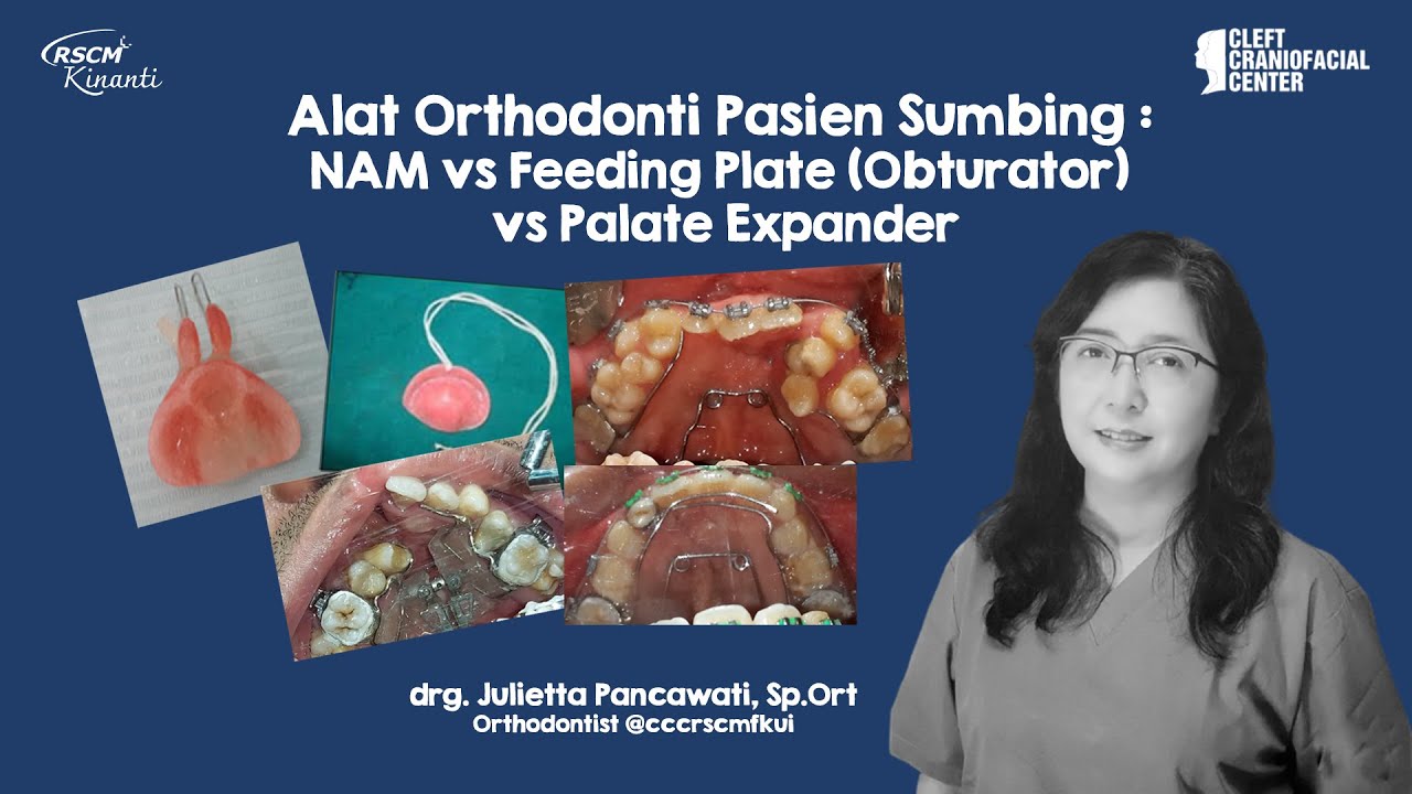 Alat Orthodonti Pasien Sumbing : NAM vs Feeding Plate (Obturator) vs ...