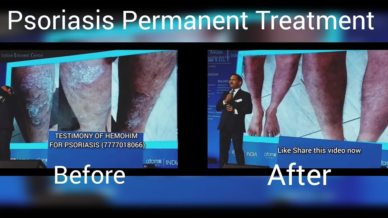 Psoriasis Permanent Treatment Testimony Of Hemohim For Psoriasis