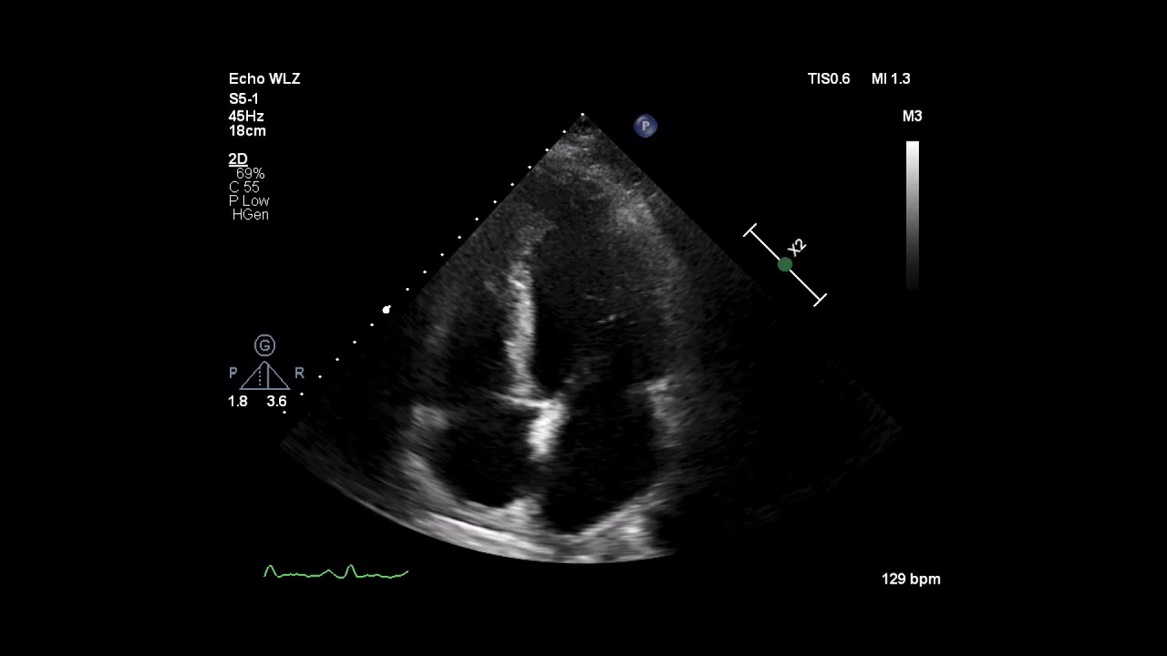 Cardiac Ultrasonogram Showing Apical 4 Chamber View - YouTube