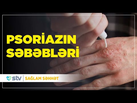 Psoriaz nədir? / Psoriazın səbəbləri / Psoriazın Müalicəsi
