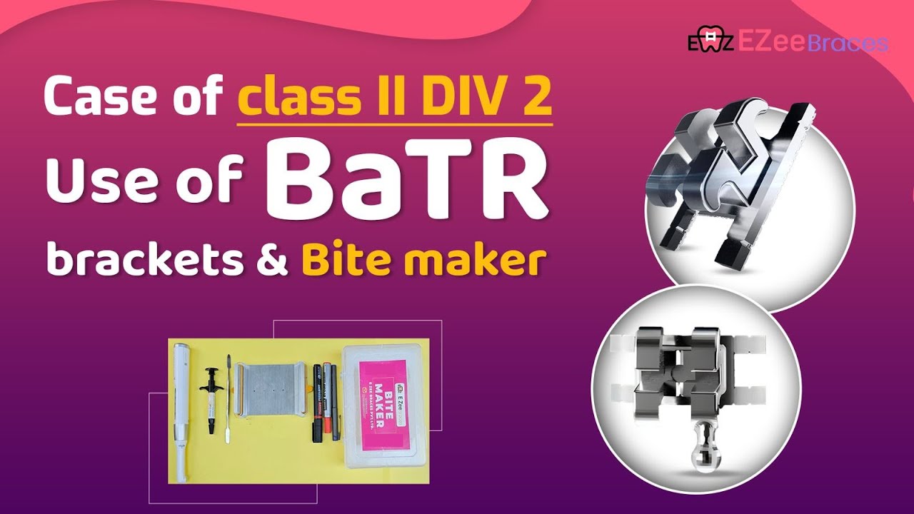 Class II Div 2 Correction | BaTR Brackets & Bite Maker | Before & After ...