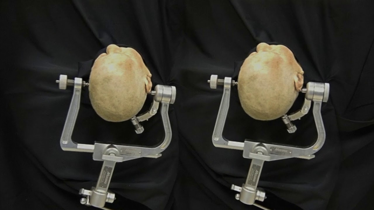 VIDEO 2: 3D (stereoscopic) video of head positioning for a pterional ...