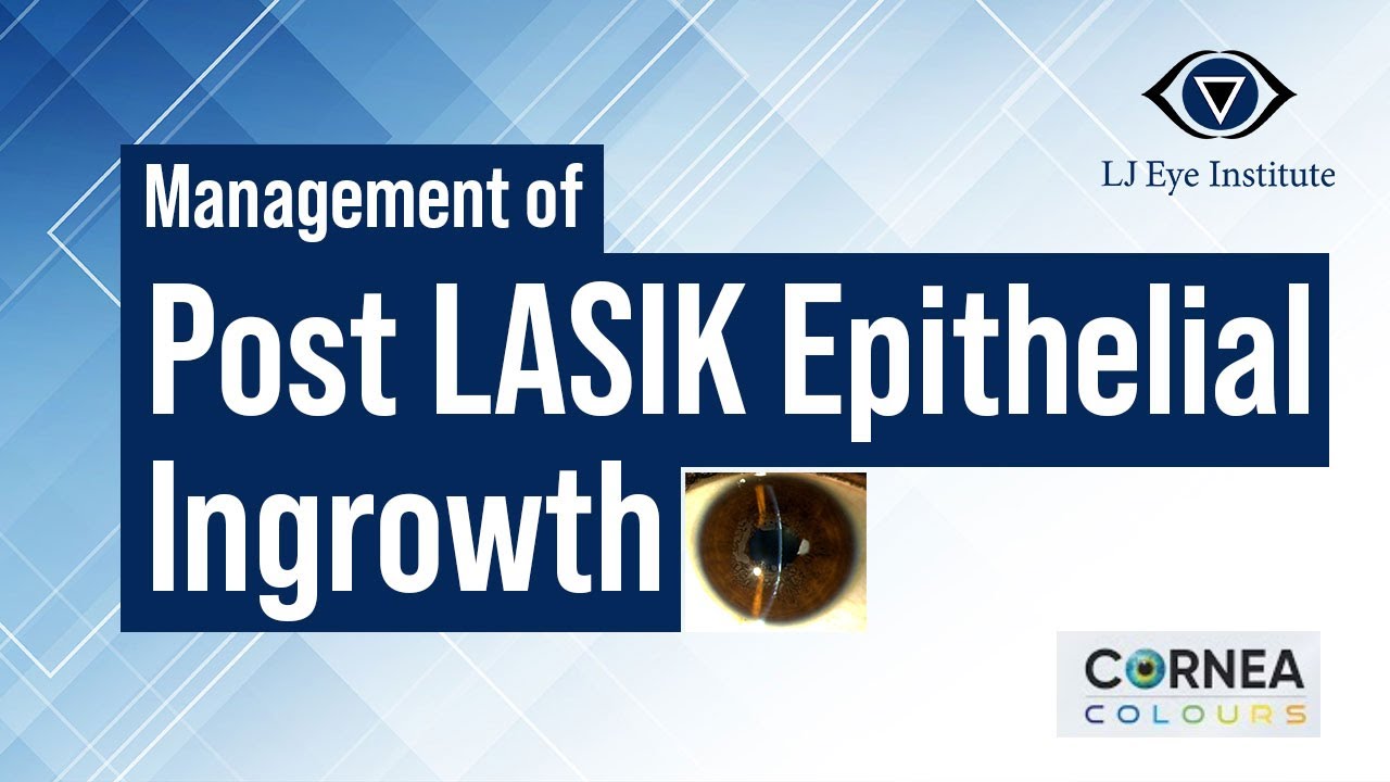 Management of Post LASIK Epithelial Ingrowth | Cornea Colours | Season ...