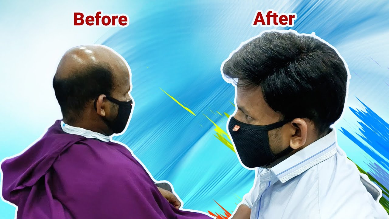 Always be Young and New. Young Once Hair Replacement Centre, Nagercoil ...