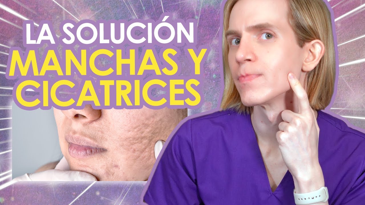 COMO BORRAR MANCHAS Y CICATRICES DE ACNE - Guia paso a paso y guia de ...
