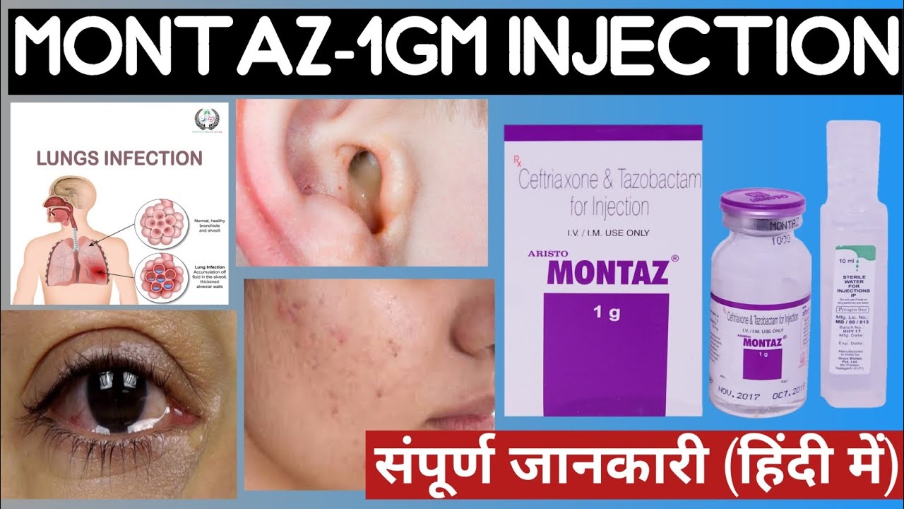 Montaz 1g injection uses in hindi |Montaz 1g | Ceftriaxone and ...