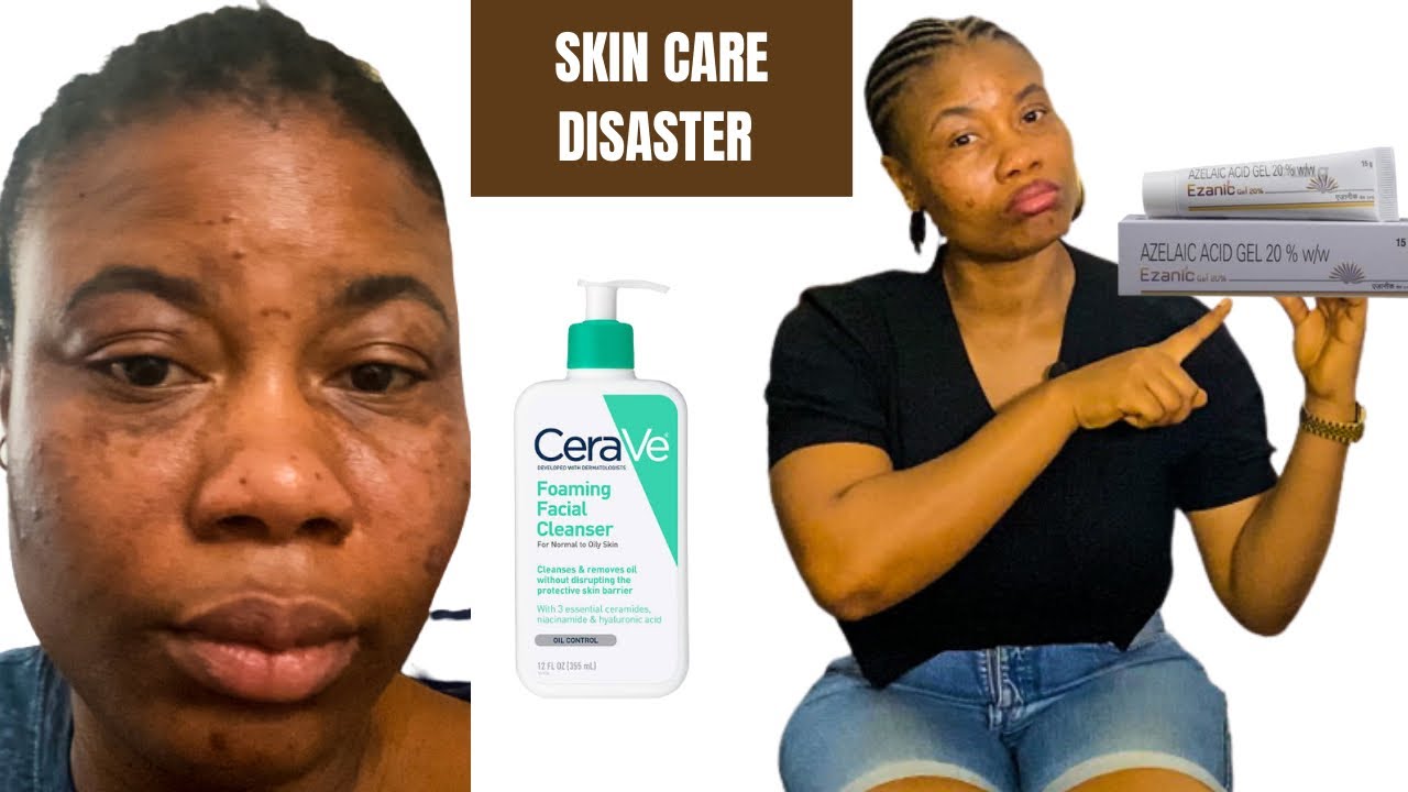 STORY TIME: SKIN CARE GONE BAD// WHAT AZELAIC ACID DID TO MY SKIN ...