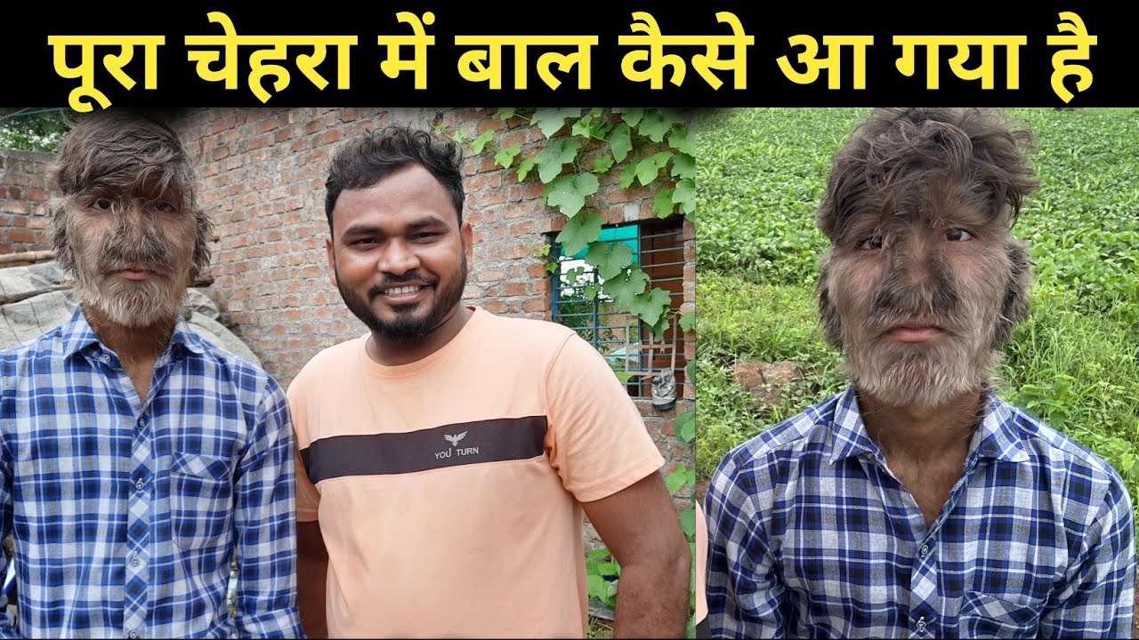 ललित बन गया बंदर || पूरा चेहरा में बाल ही बाल ||Lalit Patidar Born ...