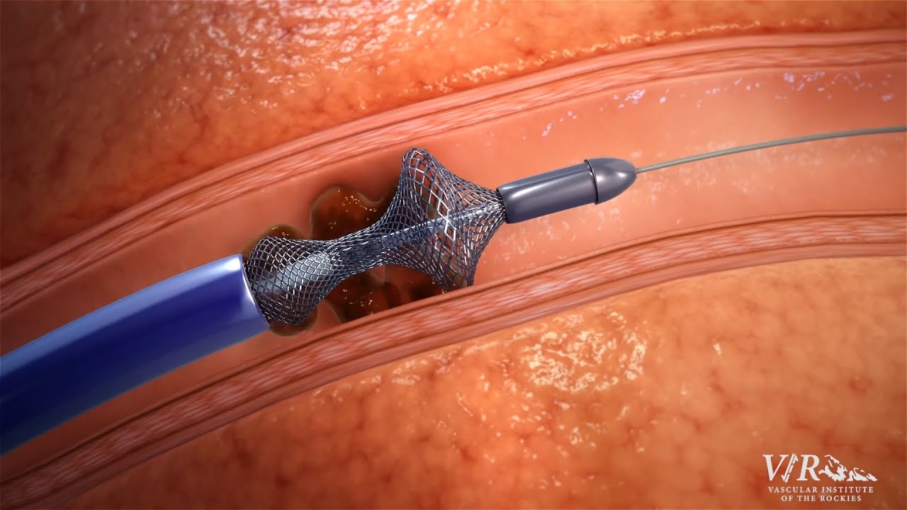 Vascular Institute of the Rockies Introduces FlowTriever Technology to ...