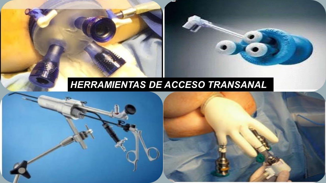 TAMIS Cirugia Transaanal Miniinvasiva por tumor o polipo rectal SILS ...