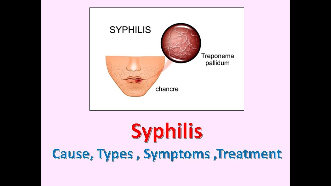 Syphilis l Symptoms l Treatment l Easy Explanation l STD l Venereal ...