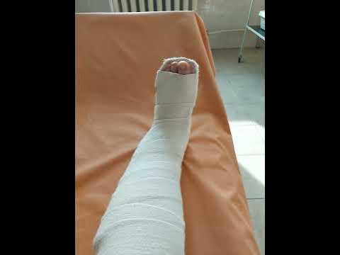 Нога на перевязке после операции ...#зима #красота #образование - YouTube