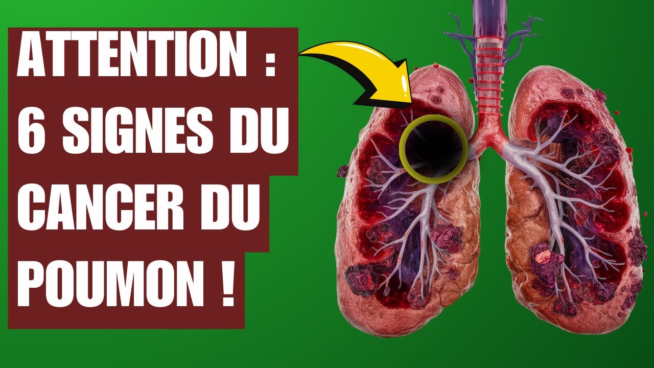 Détectez les 6 Signes de Cancer du Poumon AVANT qu'il Ne Soit Trop Tard ...