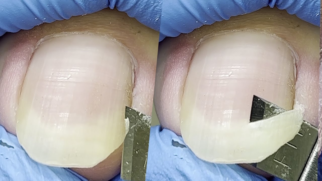 Clean toenails get a thorough trim【Xue Yidao Pedicure】 - YouTube