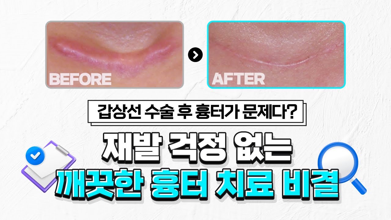 사례로 알아보는 갑상선 흉터 치료 과정 Feat 갑상선암 수술 흉터 🩹 Youtube