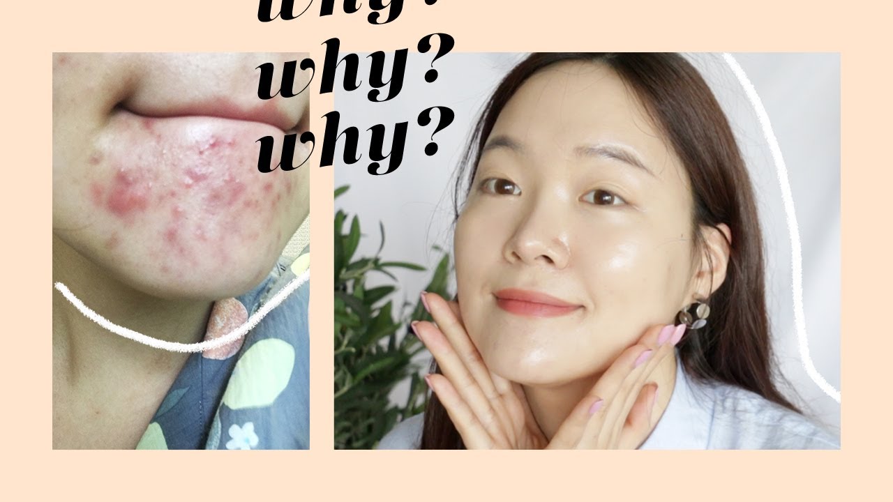 the reason why you keep on getting acne - YouTube