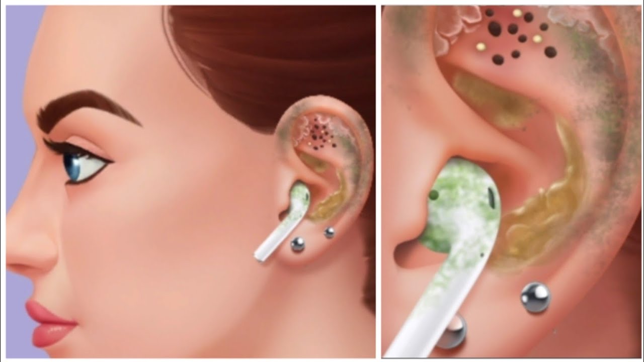 ASMR treatment remove ear piercing from infected ear|Remove stones from ...