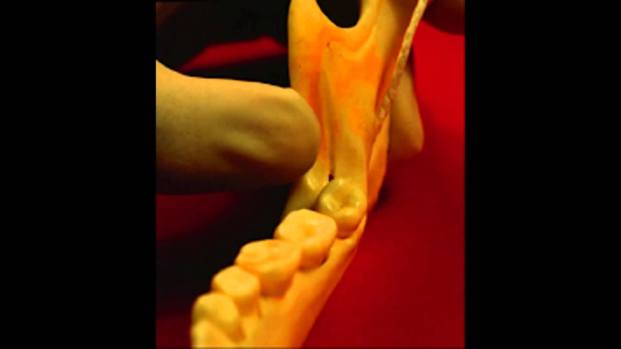 Bloqueo mandibular "A.R.T." (fc) - YouTube