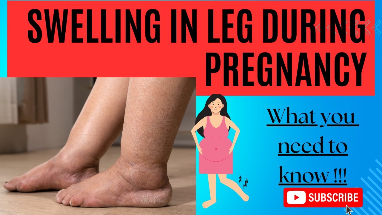Common Reasons for Swelling in leg during Pregnancy - YouTube