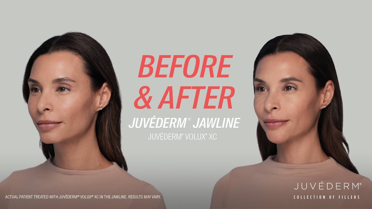 A Smooth Contour In The Jawline With JUVÉDERM® Filler | Lara’s Before ...