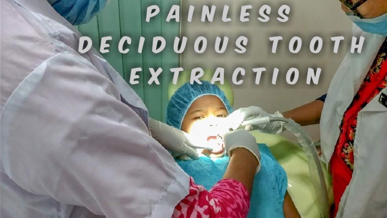 Painless Deciduous Tooth Extraction l M.S. Dental Care - YouTube