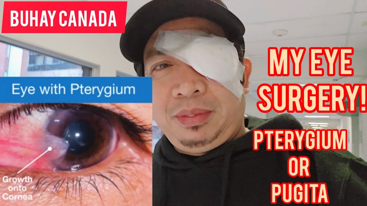 ANG OPERASYON NG AKING MATA SA CANADA 🇨🇦. - YouTube