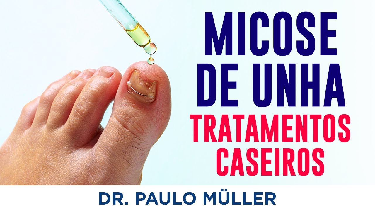 3 Tratamentos Caseiros para Micose de Unha – Dr. Paulo Müller ...