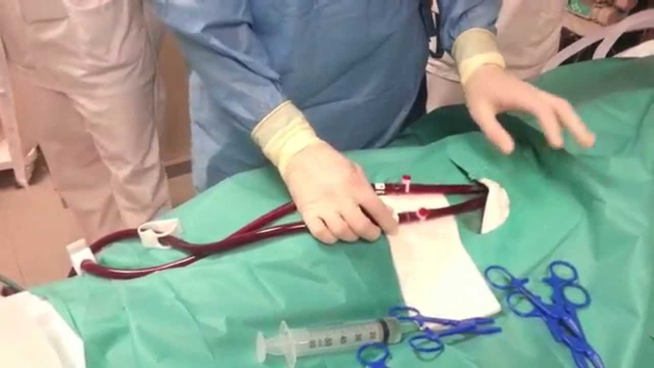 ECMO - Line Connection - YouTube