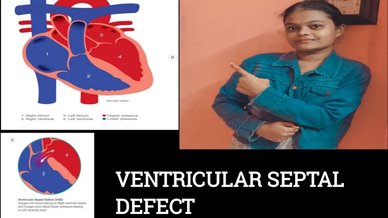 VENTRICULAR SEPTAL DEFECT(VSD)_ Definition, causes, pathophysiology ...