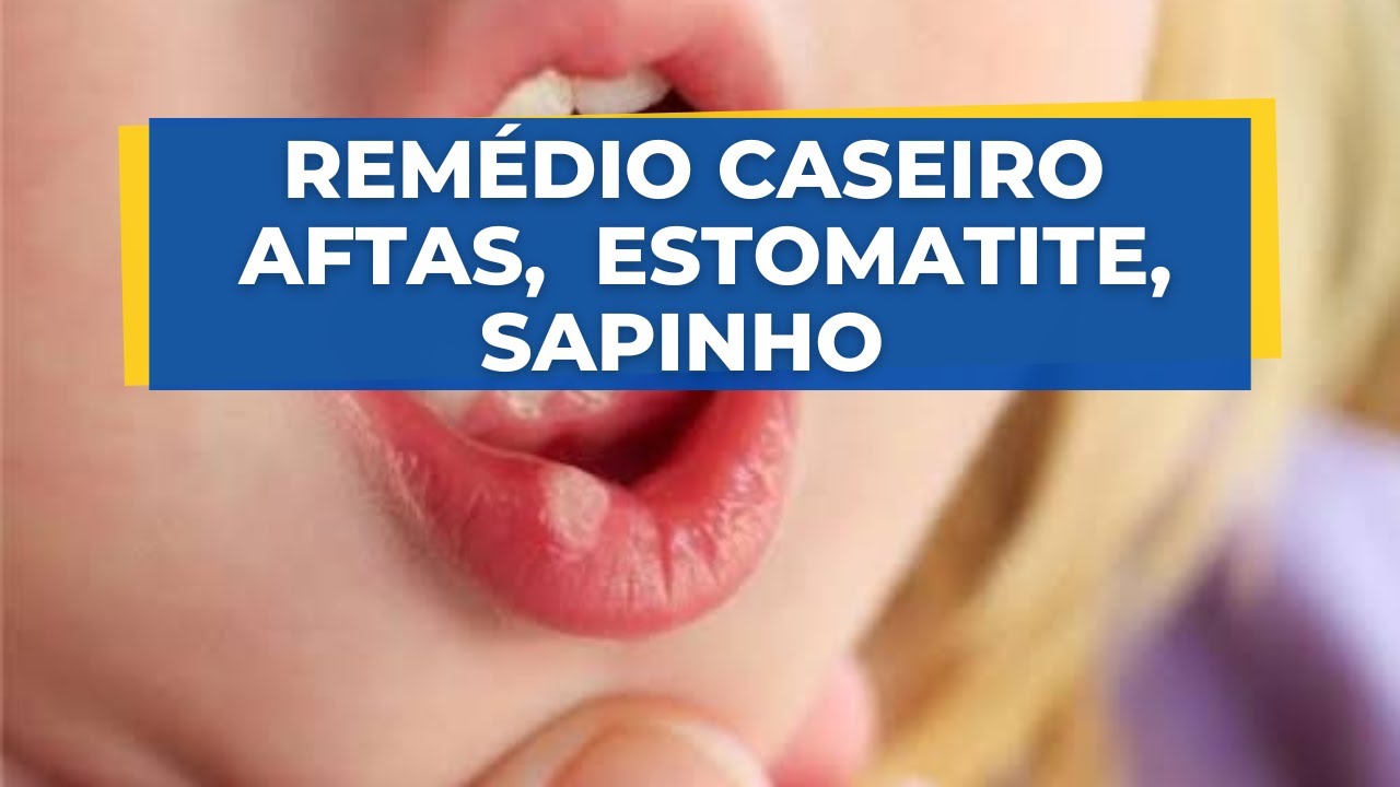 REMÉDIO CASEIRO PARA AFTAS, ESTOMATITE (SAPINHO) PARA BEBÊ E ADULTOS ...