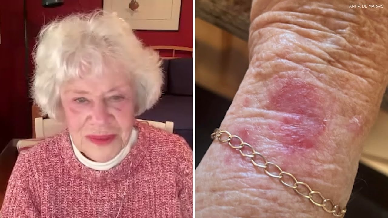 'Big red spot': 90-year-old woman reports skin irritation where she ...
