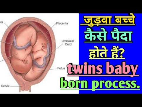 जुड़वा।।बच्चे कैसे पैदा होते हैं? माँ कैसे बने।।twins baby born process ...