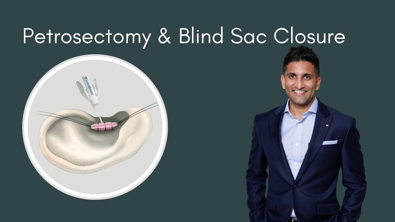 30. Subtotal Petrosectomy and Blind Sac Closure - 10 minute overview ...