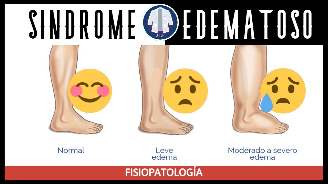 ¿Por qué tenemos edemas? | EXPLICADO Dr. JR - YouTube