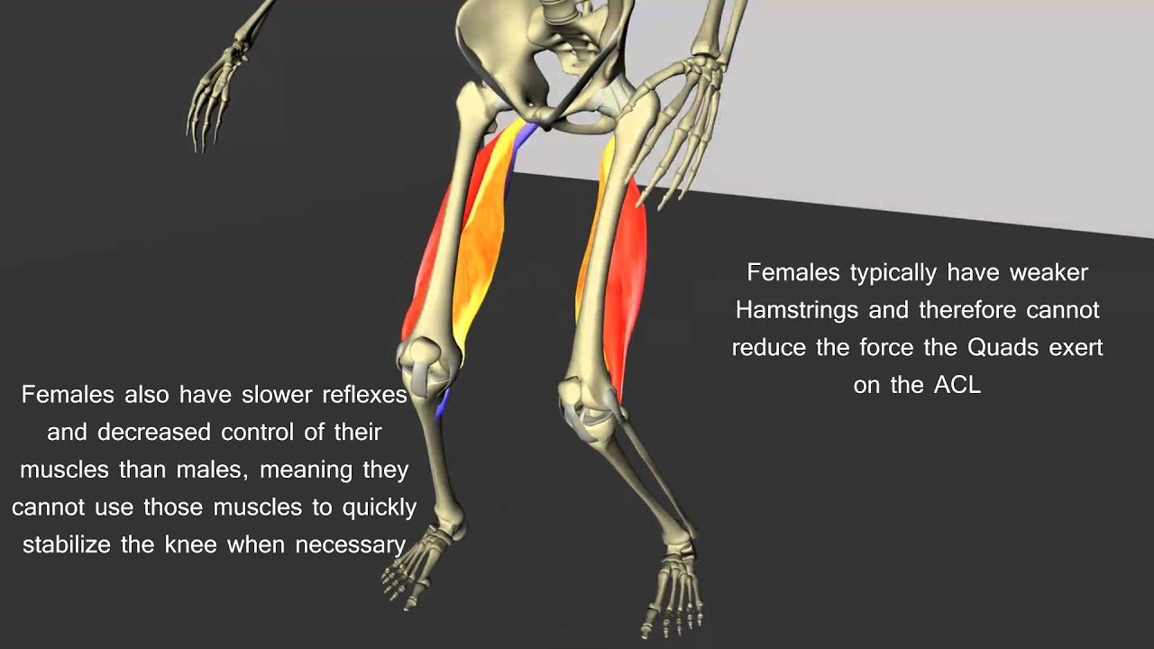Non Contact Injury To The Anteior Cruciate Ligament YouTube non-contact-injury-to-the-anteior-cruciate-ligament-youtube