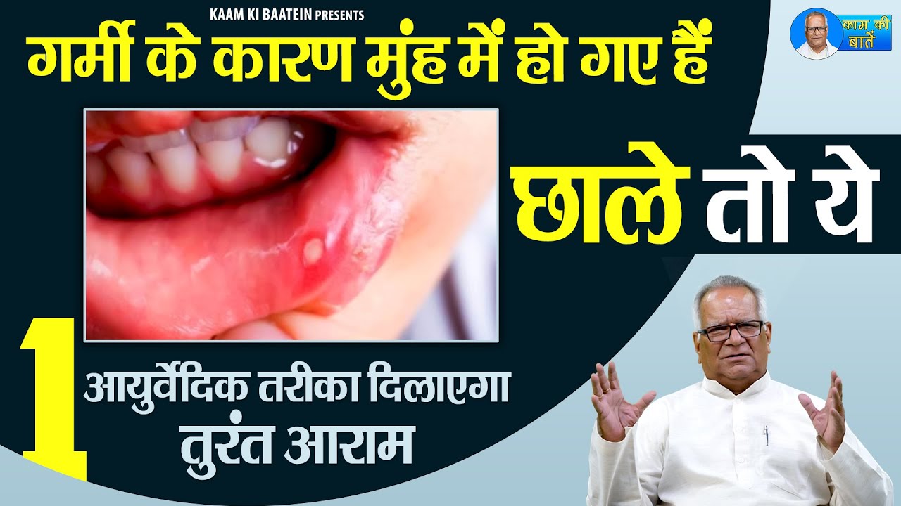 मुंह के छाले दूर करने के घरेलु उपाय | Mouth Ulcers | Muh Ke Chale Kaise ...