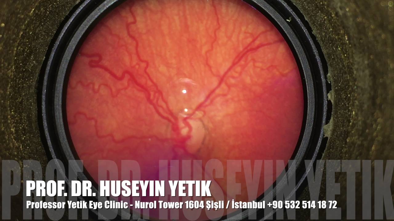 ROP - Prematüre Retinopatisi - 4K INDIRECT OPHTHALMOSCOPIC IMAGING OF A ...