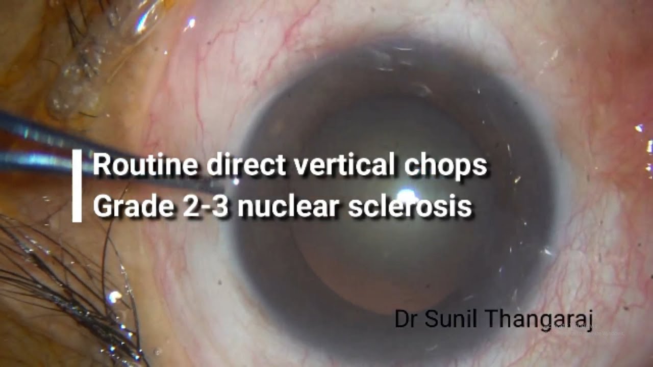 Routine direct vertical chops for a grade 2-3 nuclear sclerosis - a ...